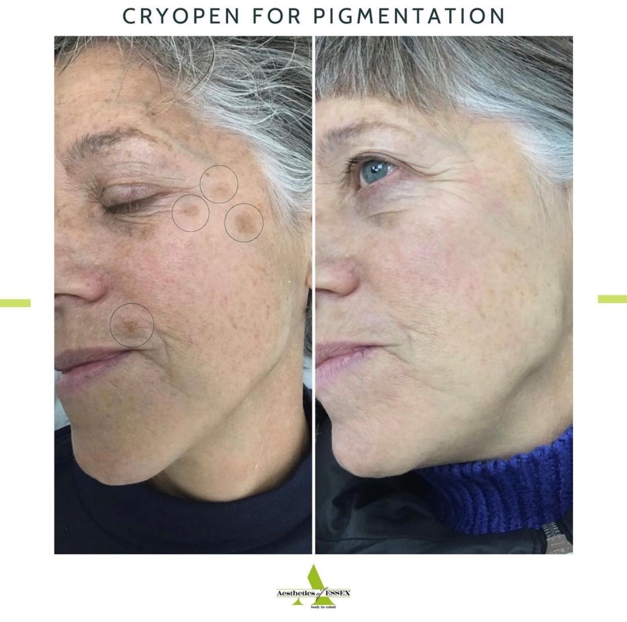CryoPen Treatments | Skin Tag Removal Essex - Aesthetics of Essex