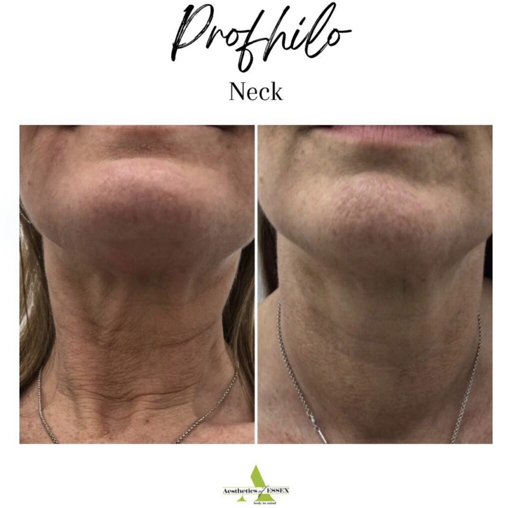 Profhilo Treatments in Essex Available from Aesthetics of Essex